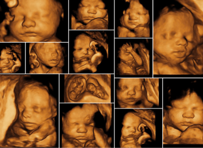 "Exploring 3D and 4D Ultrasound: Benefits, Differences, and FAQs" - Packagesly.com