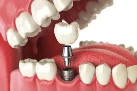 Modern Dental Implant Options for Tooth Replacement - Packagesly.com